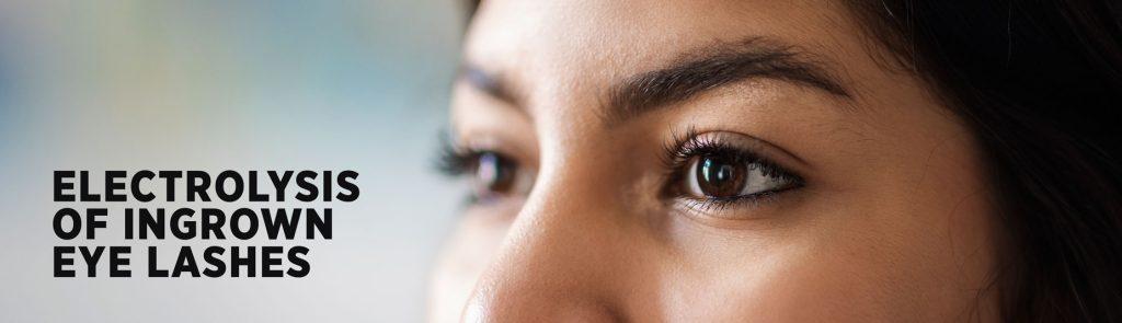 Electrolysis of Ingrown Eye Lashes - Cathedral Eye Clinic